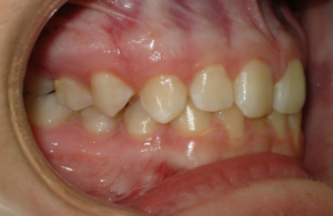 Cross Bite Before and After Braces Pictures | McCormick Orthodontics