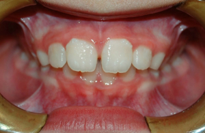 Braces Before and After | Photo Gallery | McCormick Orthodontics