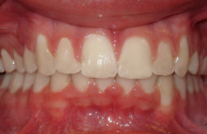 Protrusion Before and After Braces Pictures | McCormick Orthodontics