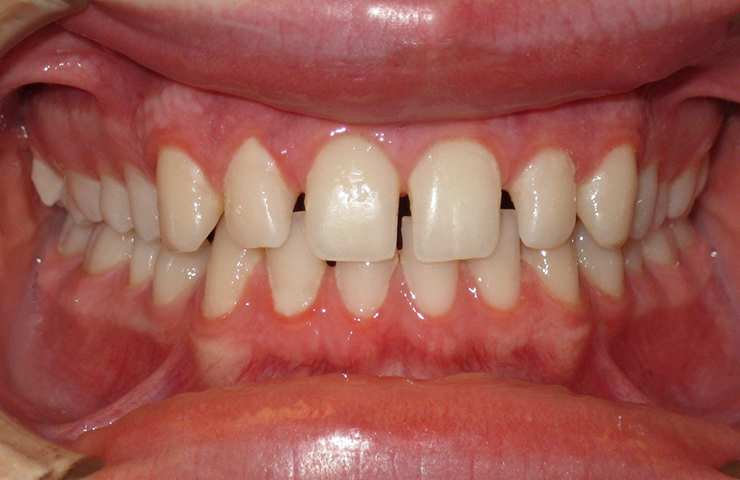 Spacing Before And After Braces Pictures McCormick Orthodontics